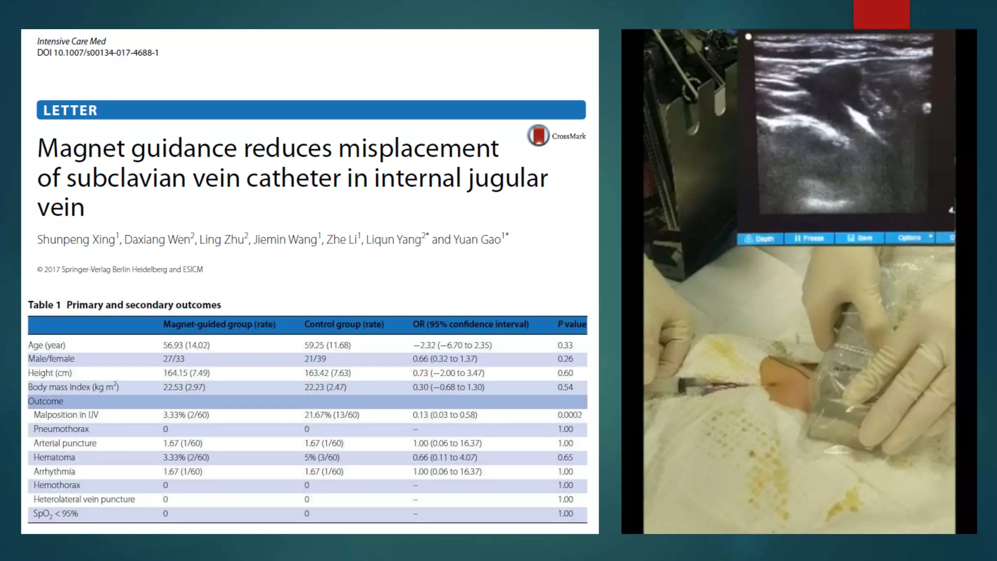 Ultrasound guided subclavian vein catheterization in pediatric patients ...