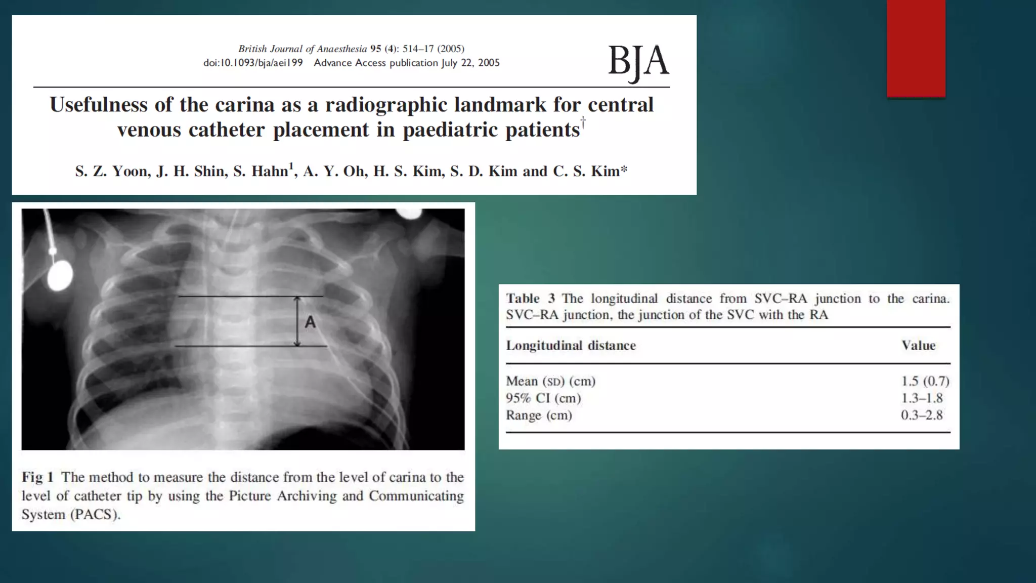 Ultrasound guided subclavian vein catheterization in pediatric patients ...