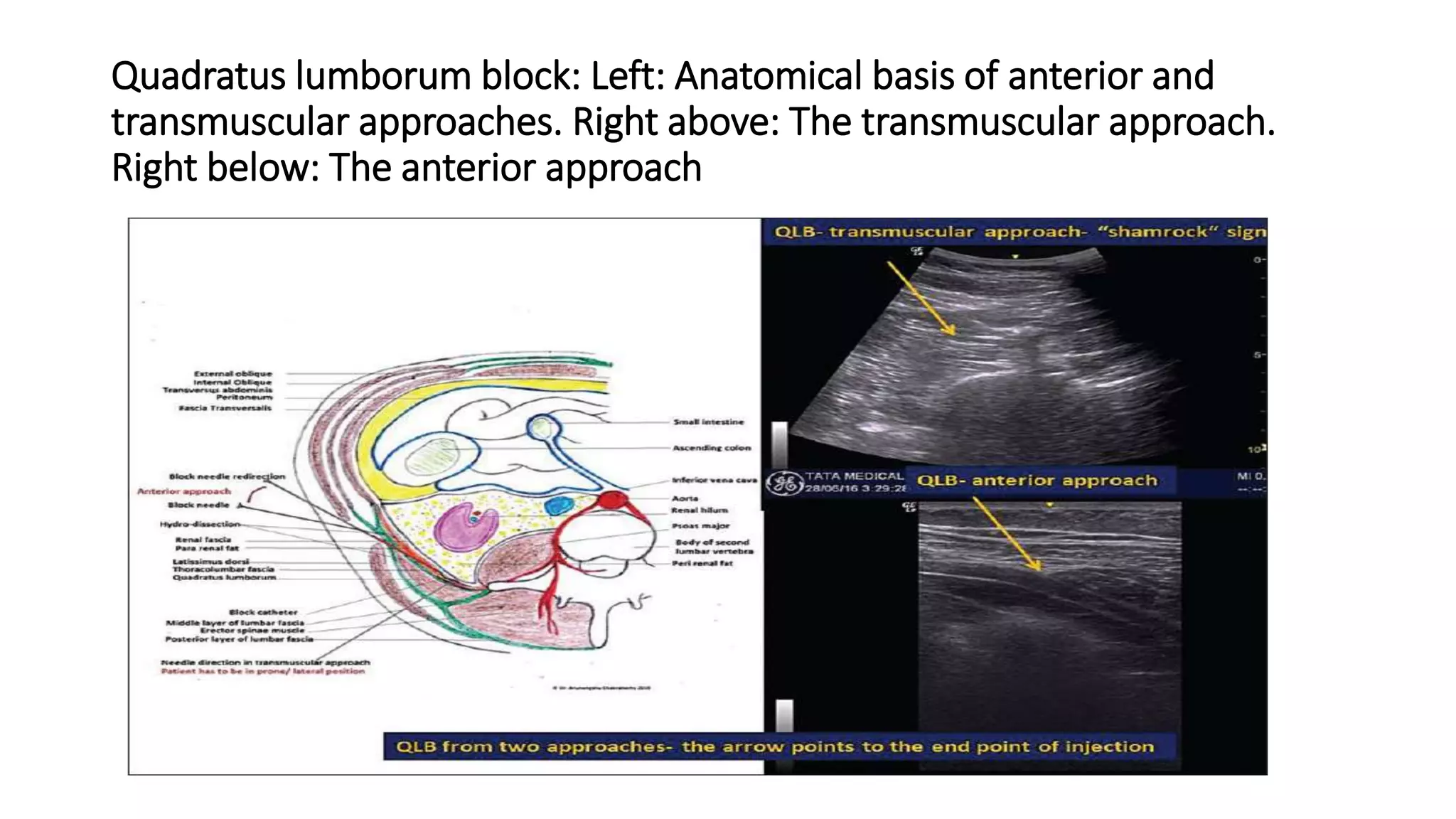 Ultrasound guided truncal blocks | PPTX