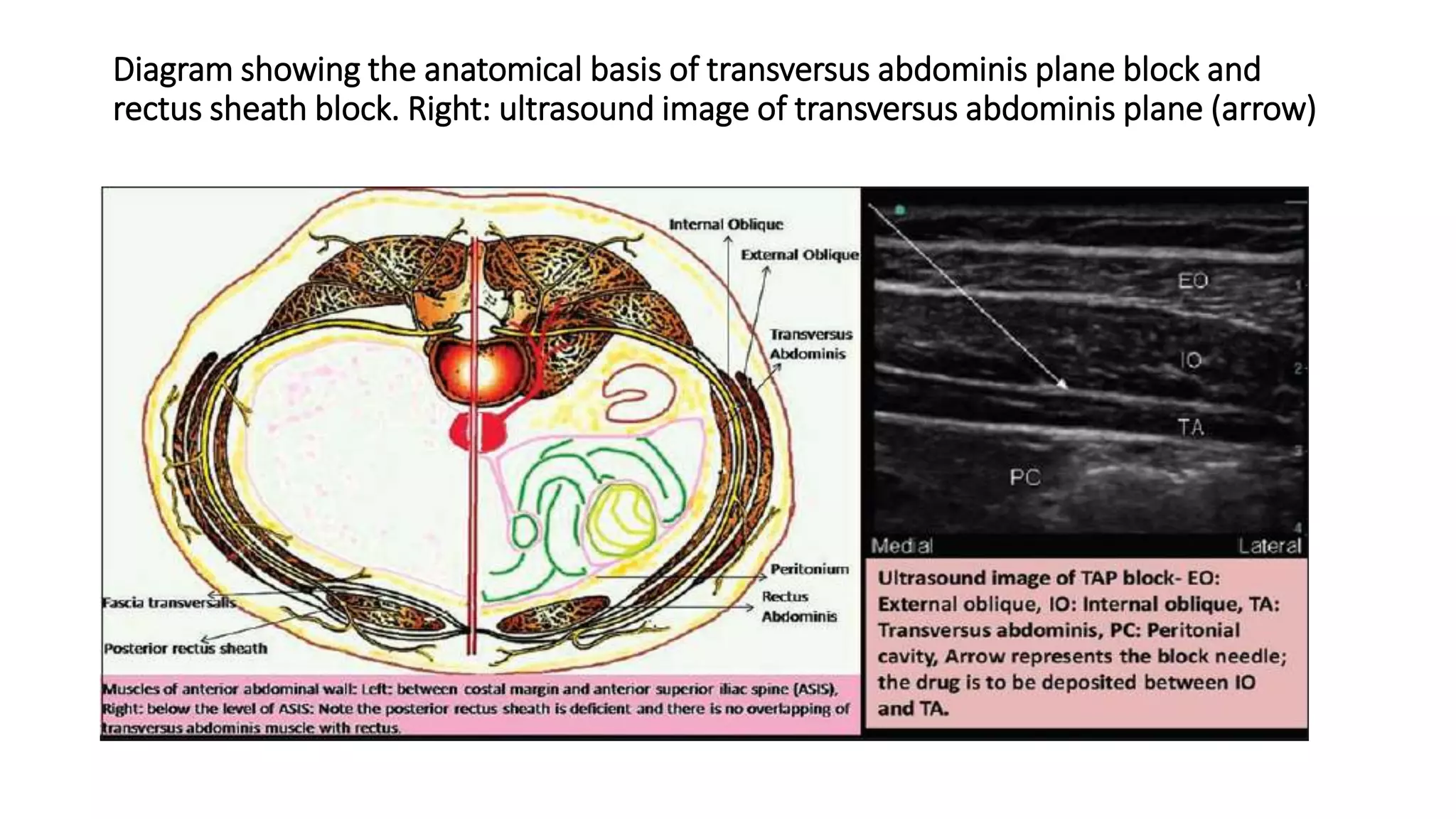 Ultrasound guided truncal blocks | PPTX