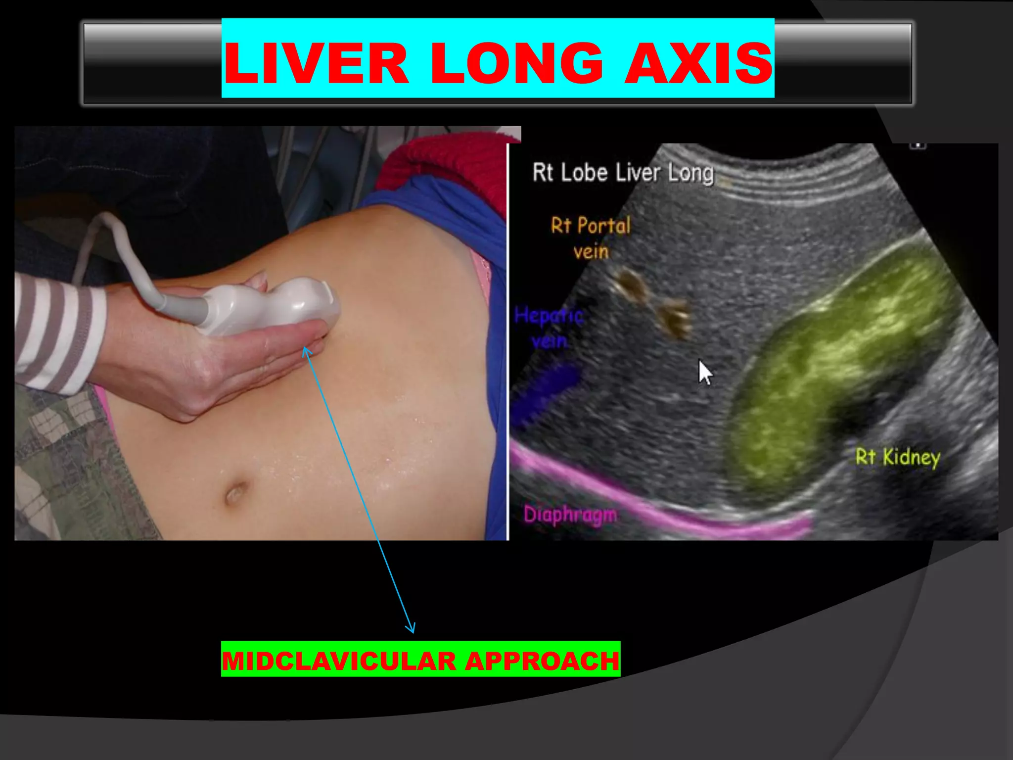 How to do Liver Ultrasound | PDF