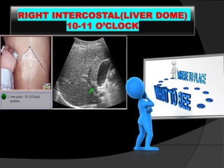How to do Liver Ultrasound | PDF