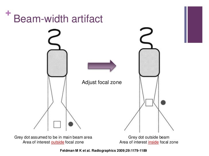 Beam width artifact. : 네이버 블로그