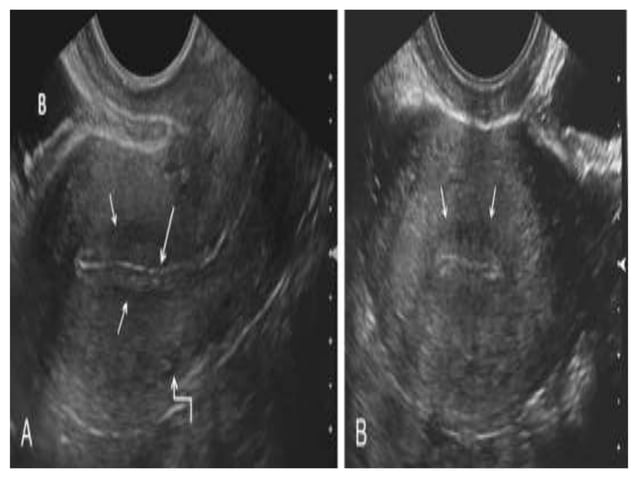 What is uterus Layers of Uterus and 2.pptx