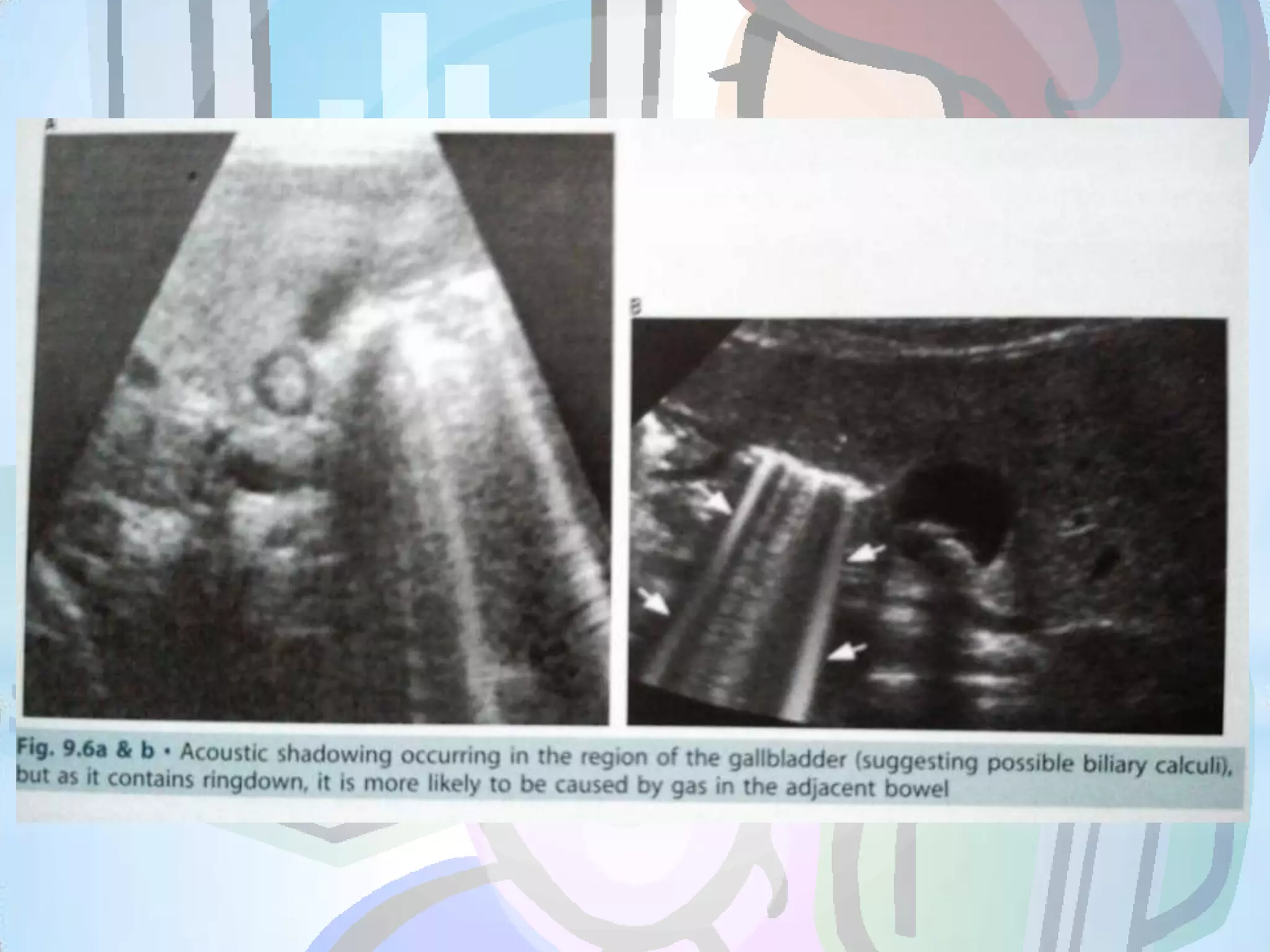 Ultrasound artifacts | PPTX