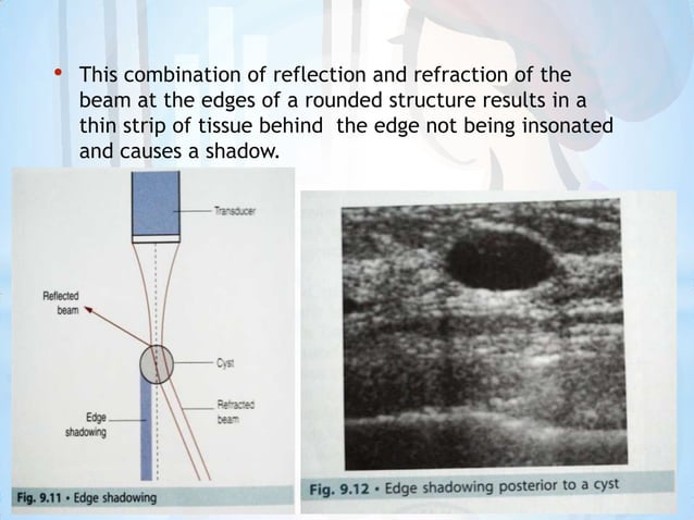Ultrasound artifacts | PPTX | Digital Audio | Computer Software and Applications
