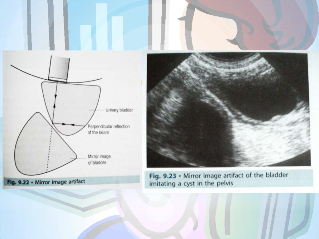 Types Of Ultrasound Artifacts Ultrasound Imaging Artifacts: How To