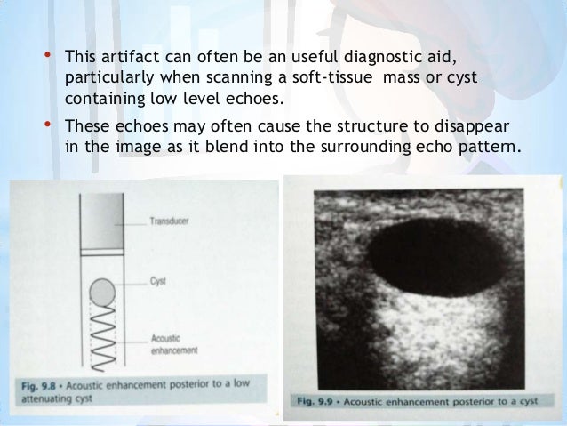 Ultrasound artifacts