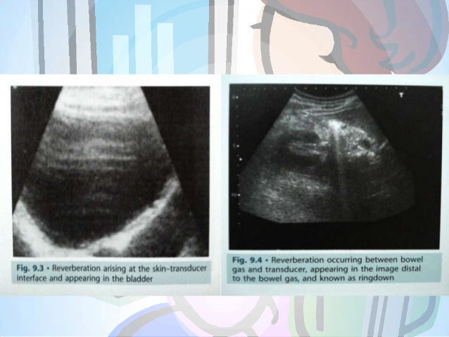 Ultrasound artifacts