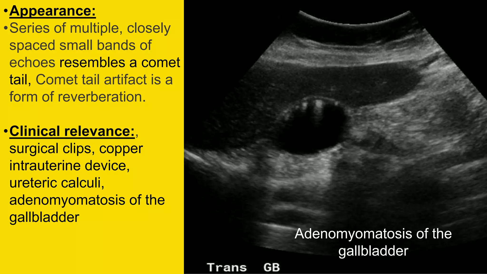 Ultrasound artifacts | PPTX