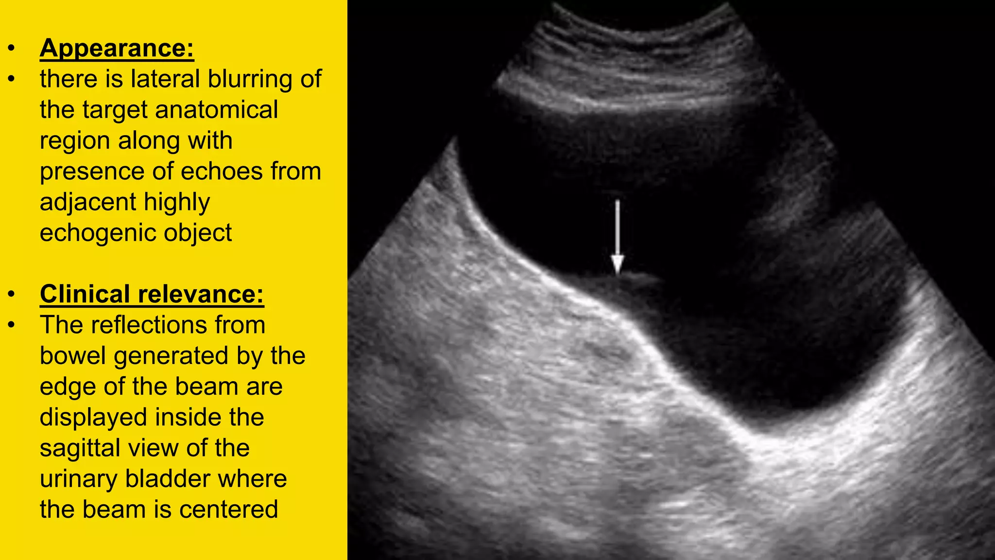 Ultrasound artifacts | PPTX