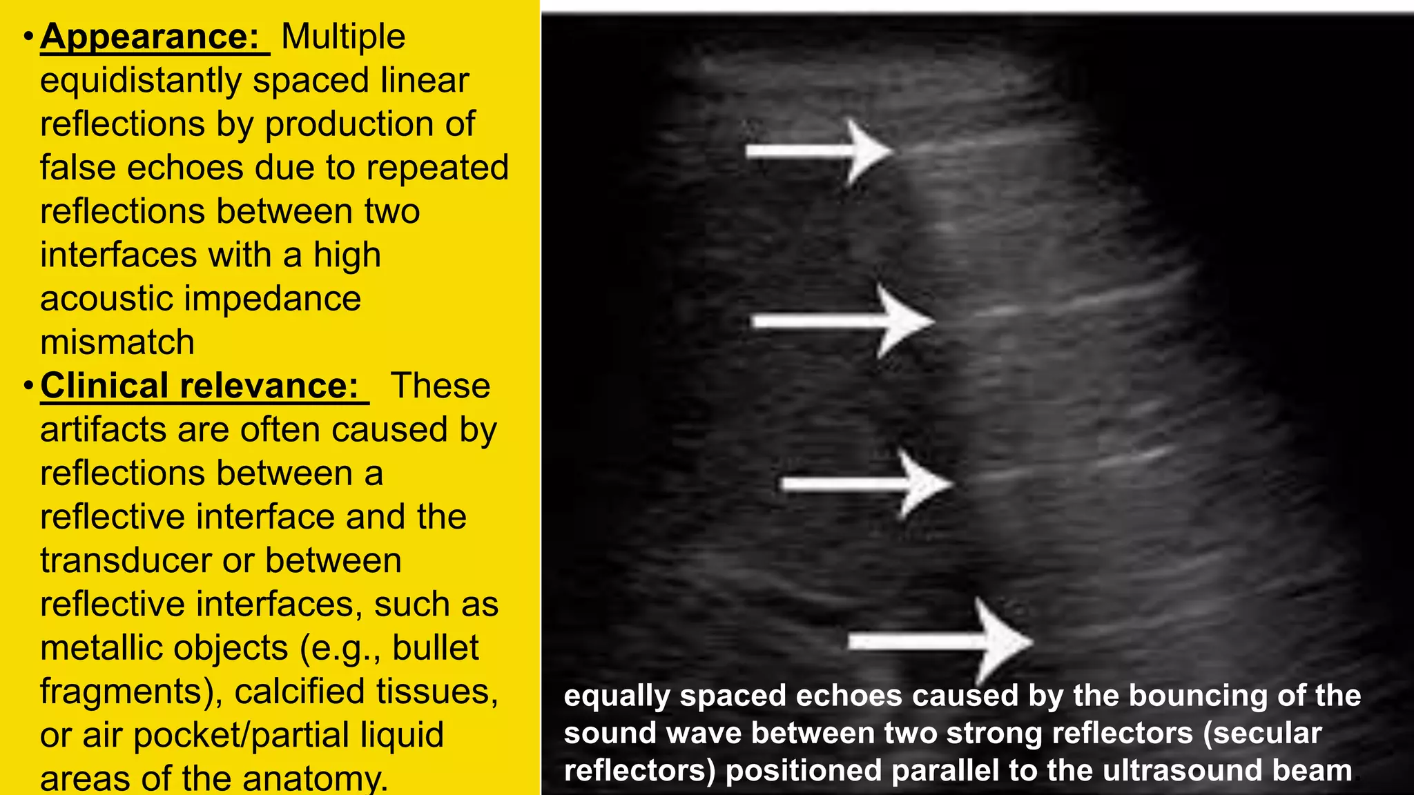 Ultrasound artifacts | PPTX