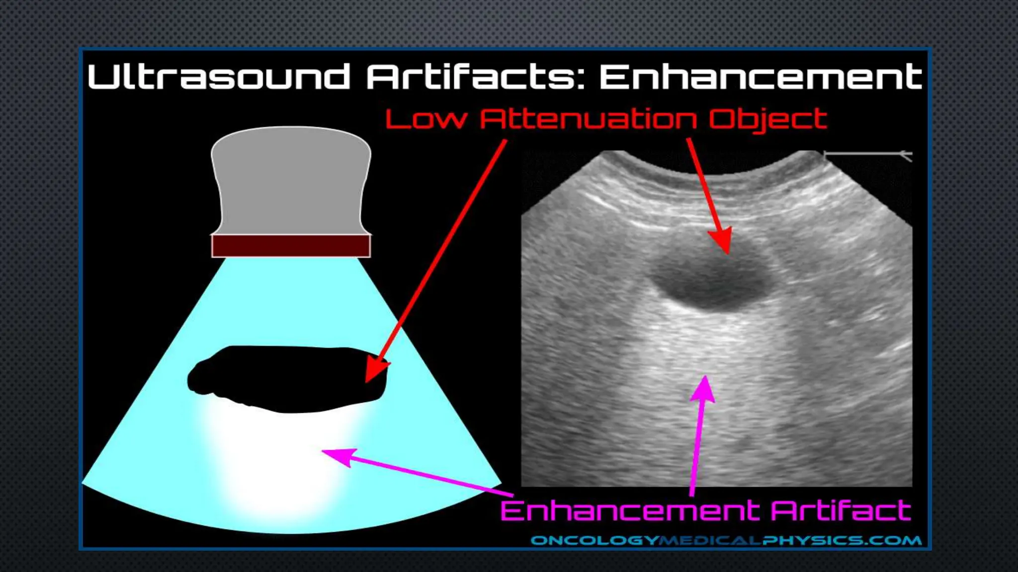 ULTRASOUND ARTIFACTS.pptx
