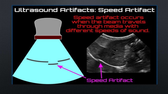 ULTRASOUND ARTIFACTS.pptx