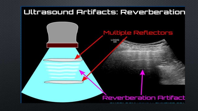 ULTRASOUND ARTIFACTS.pptx