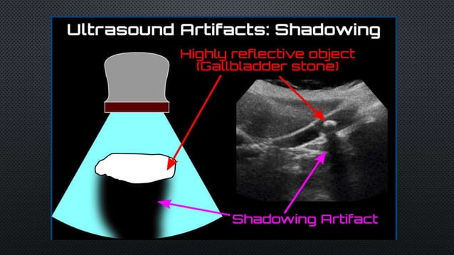 ULTRASOUND ARTIFACTS.pptx