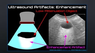 ULTRASOUND ARTIFACTS.pptx