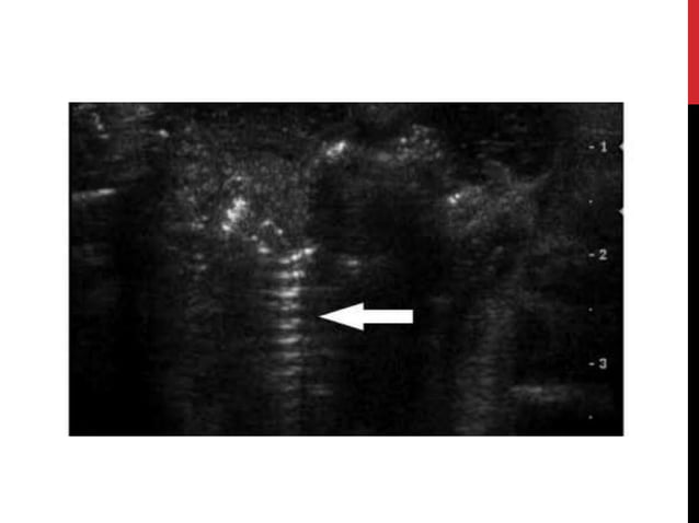 Ultrasound artifacts and contrast enhanced ultrasound | PPTX | Digital ...