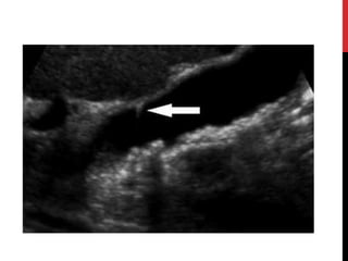 Ultrasound artifacts and contrast enhanced ultrasound | PPTX