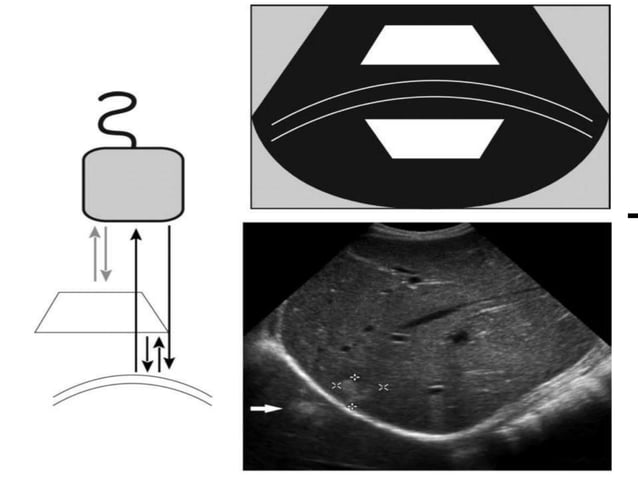 Ultrasound artifacts and contrast enhanced ultrasound | PPTX | Digital ...