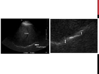 Ultrasound artifacts and contrast enhanced ultrasound | PPTX