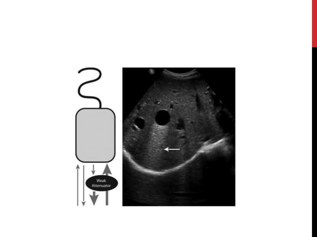 Ultrasound artifacts and contrast enhanced ultrasound | PPTX | Digital ...