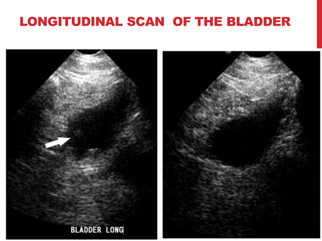 Ultrasound artifacts and contrast enhanced ultrasound | PPT