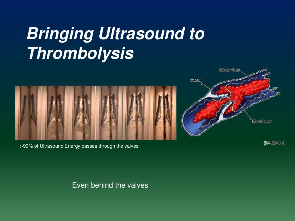 Ultrasound Assisted Thrombolysis For Vte Turkish Experience