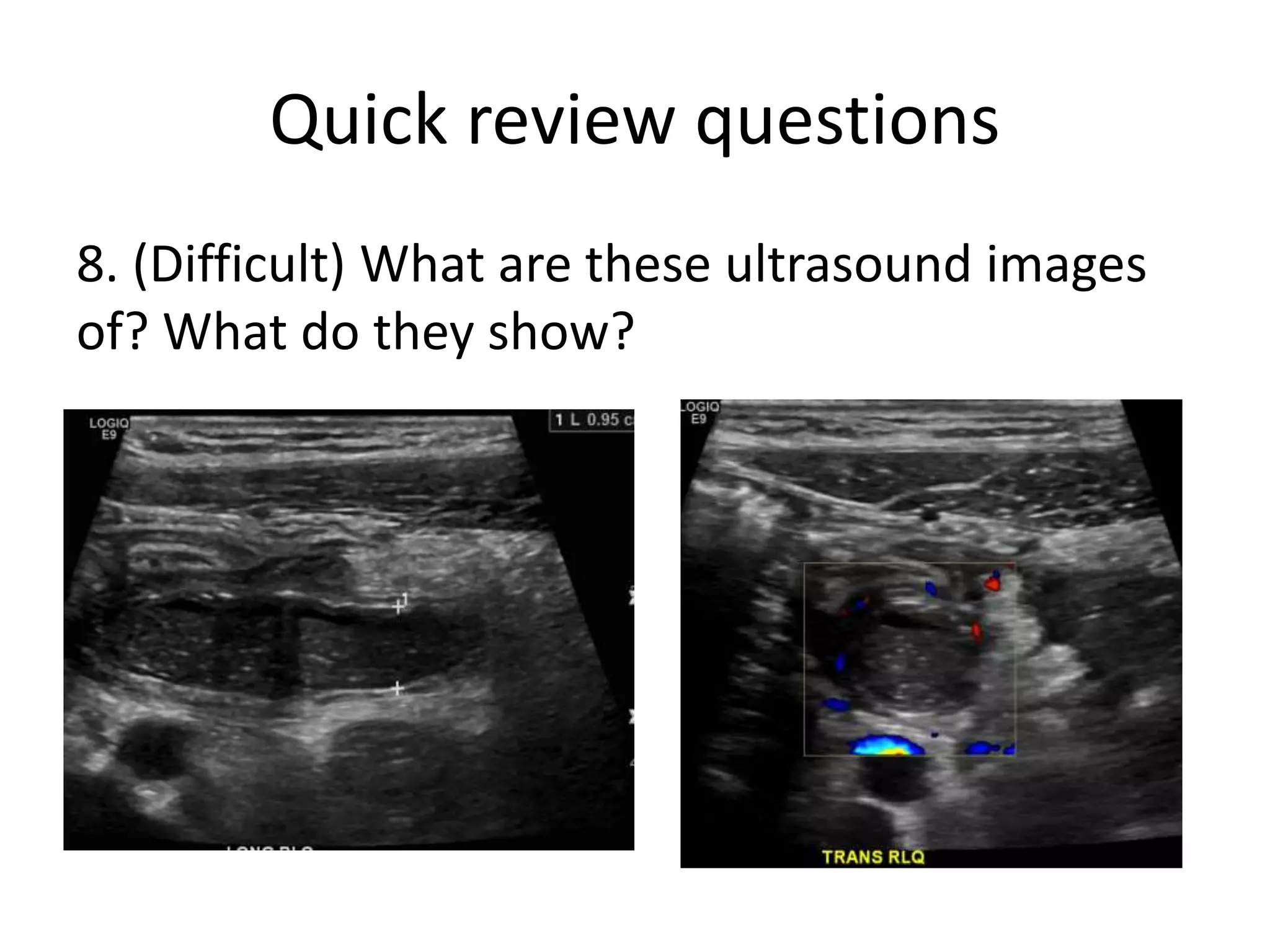 Ultrasound Basics.ppt