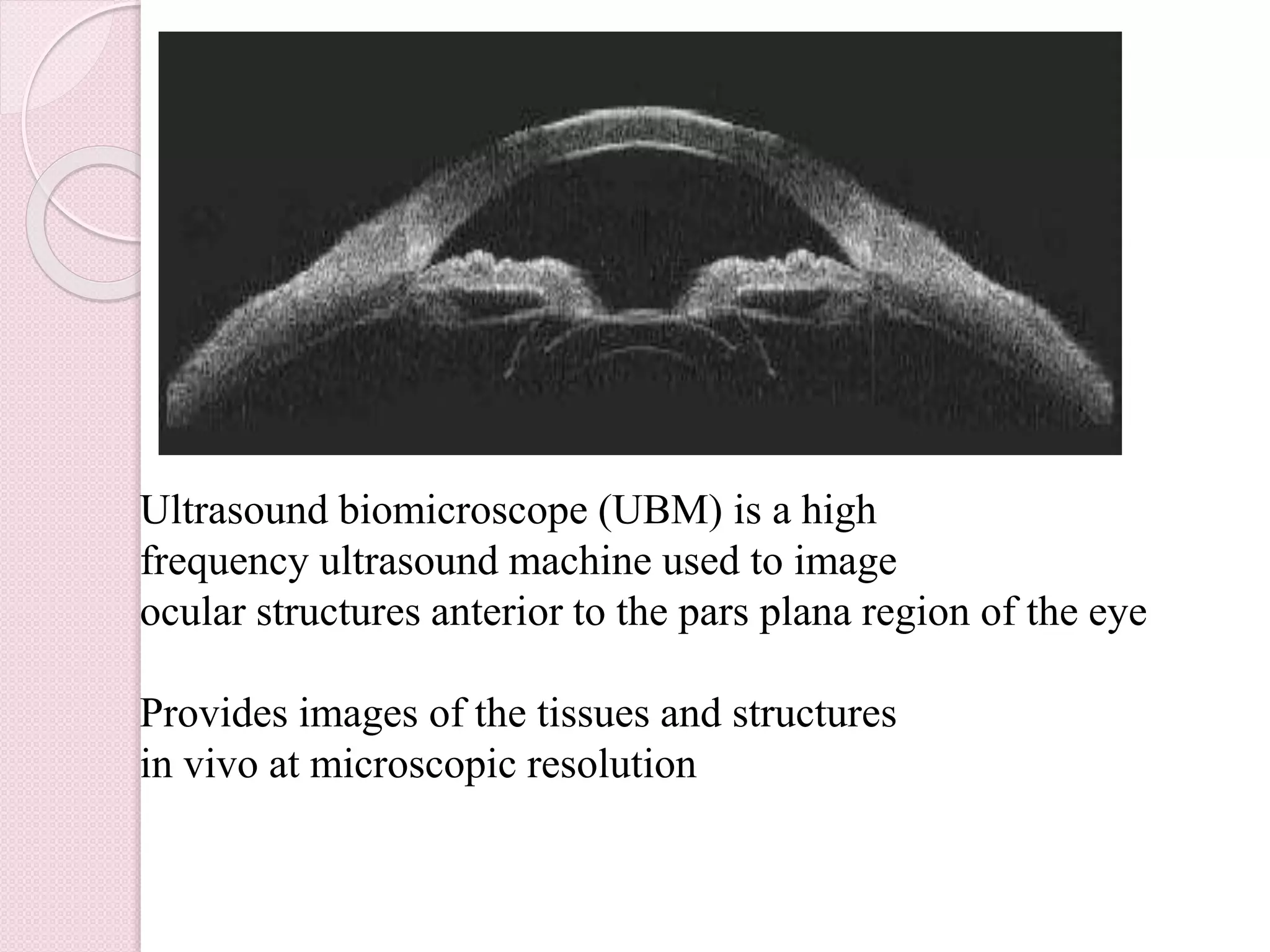 Ultrasound biomicrosopy in glaucoma | PPTX