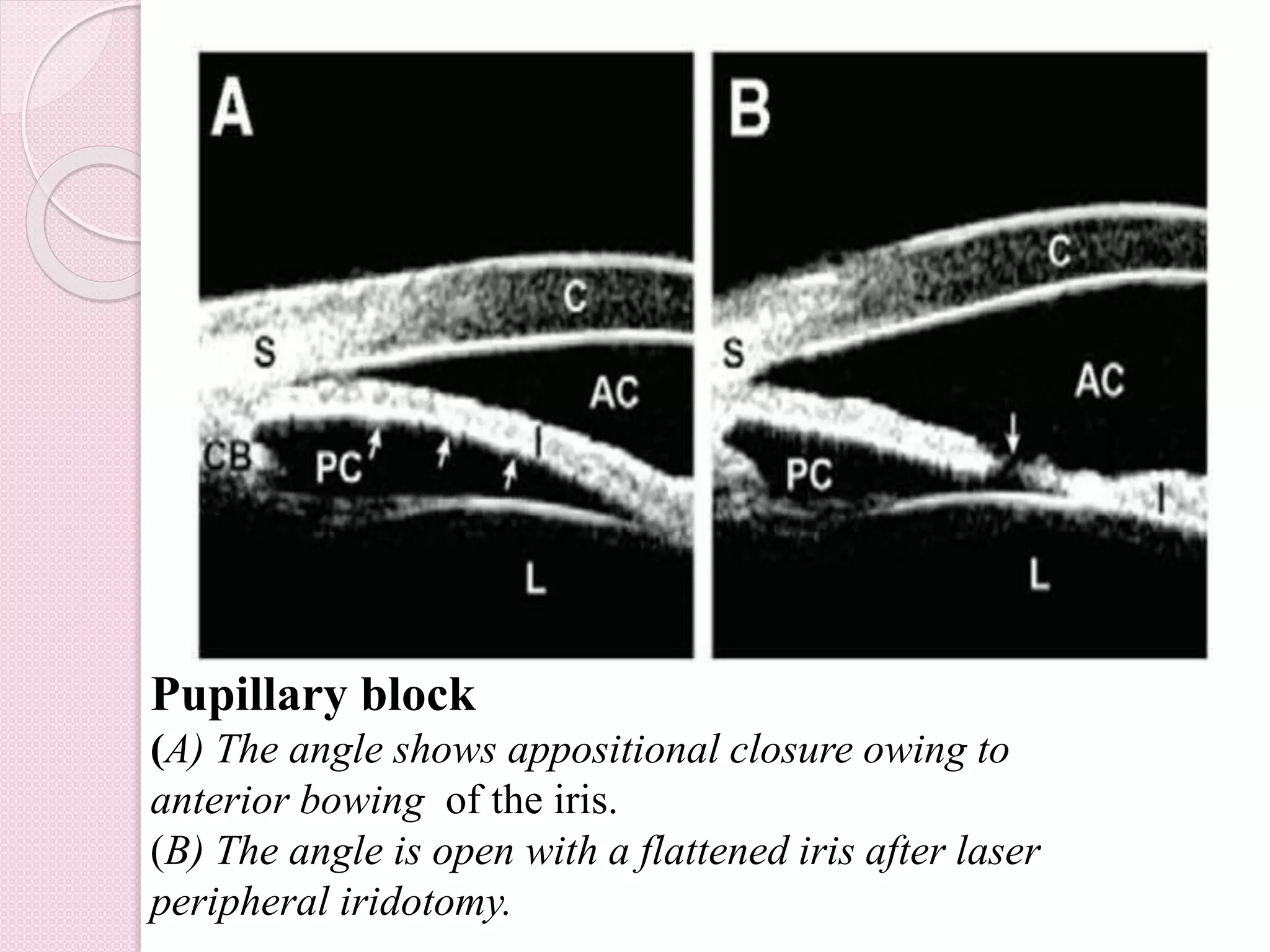 Ultrasound biomicrosopy in glaucoma | PPTX