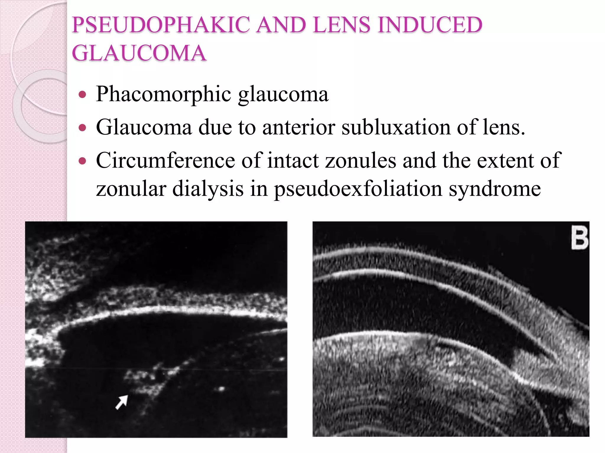 Ultrasound biomicrosopy in glaucoma | PPTX