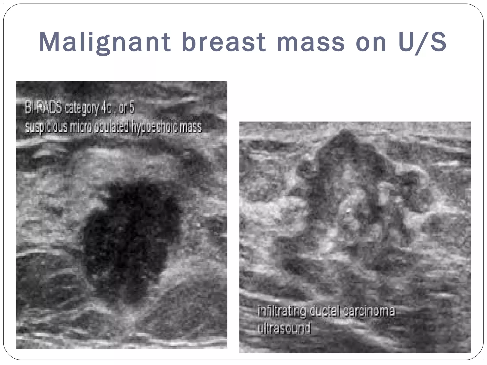 Ultrasound breast mass | PPT