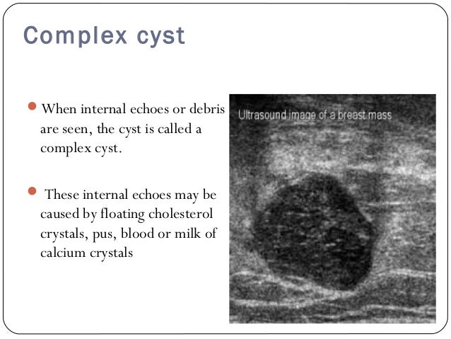Ultrasound breast mass