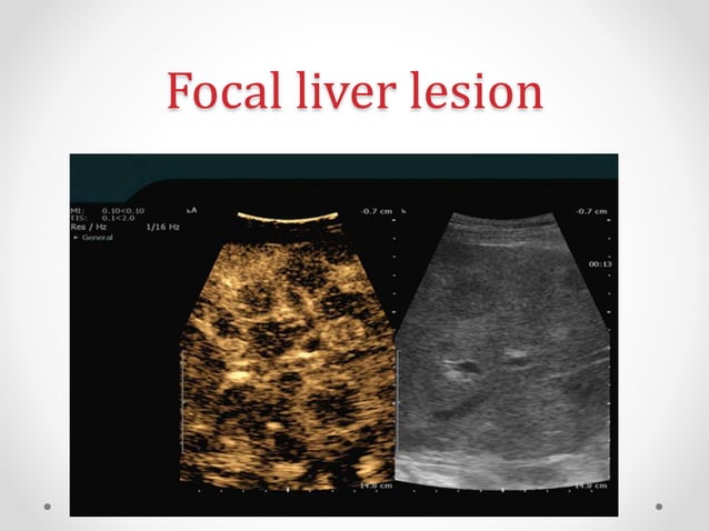 Ultrasound contrast agents | PPTX