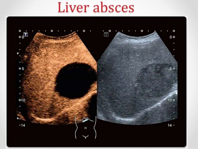 Ultrasound contrast agents
