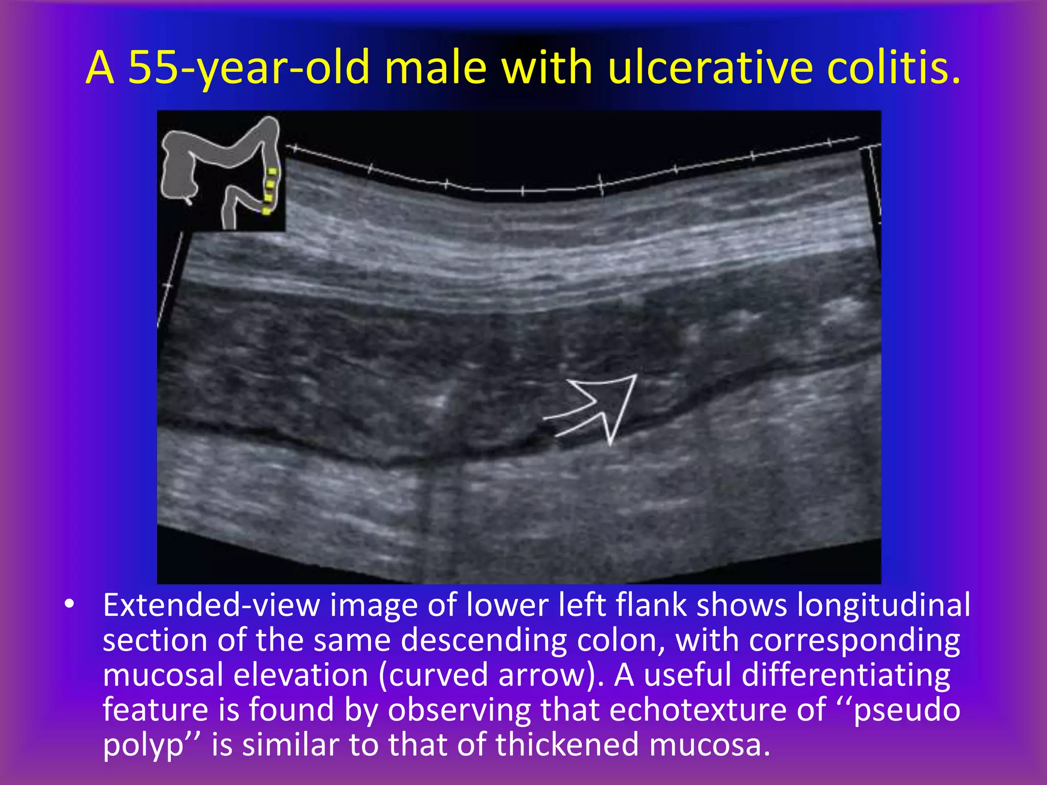 Ultrasound detection of colonic polyps Dr. Muhammad Bin Zulfiqar | PPTX