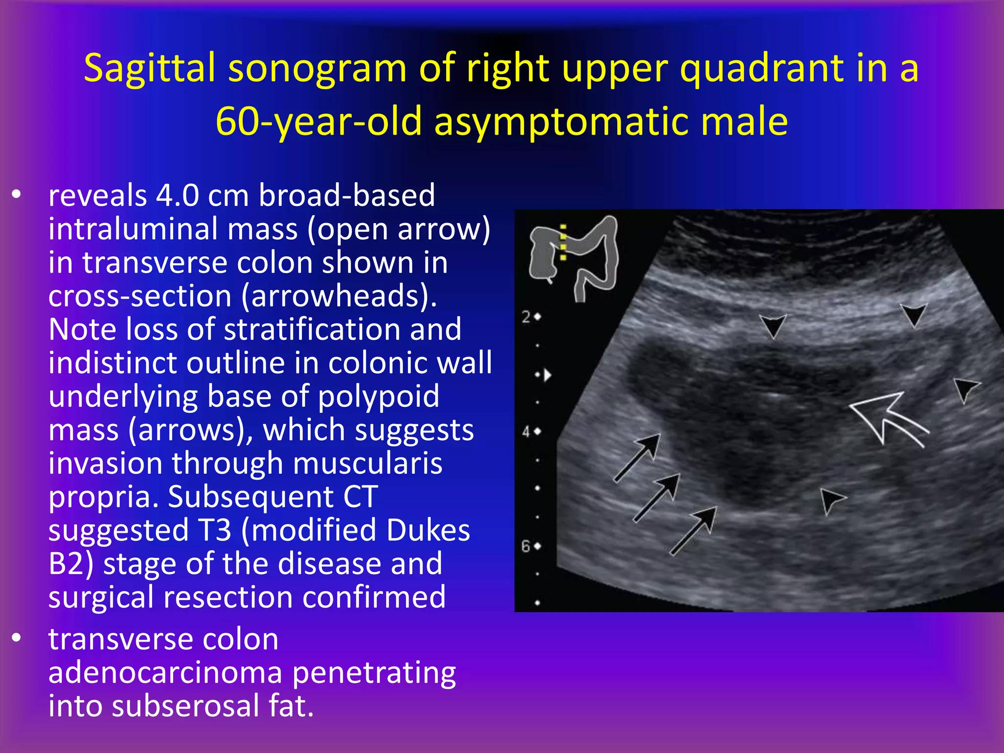 Ultrasound detection of colonic polyps Dr. Muhammad Bin Zulfiqar | PPTX