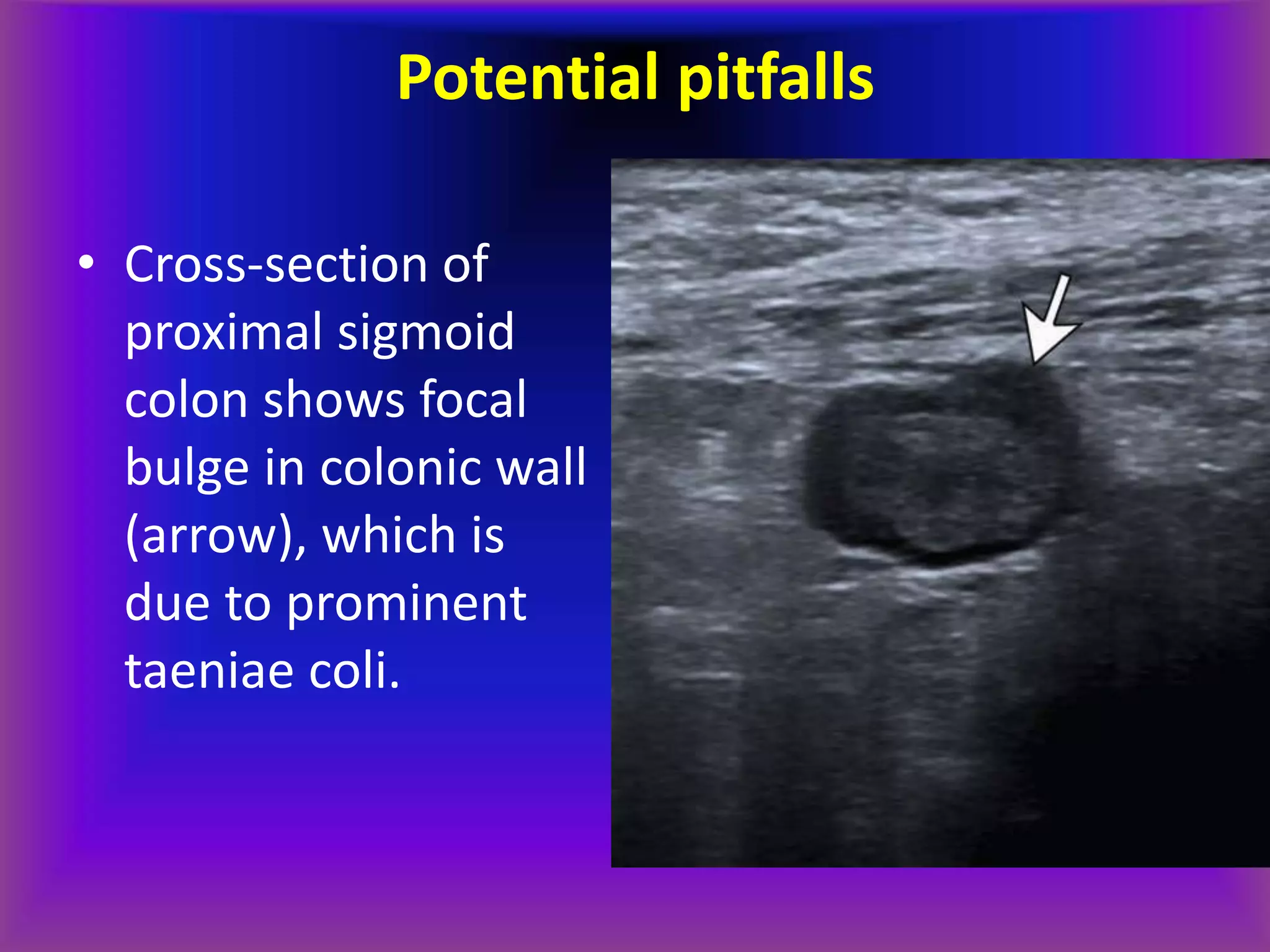Ultrasound detection of colonic polyps Dr. Muhammad Bin Zulfiqar | PPTX
