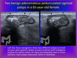 Ultrasound detection of colonic polyps Dr. Muhammad Bin Zulfiqar | PPTX