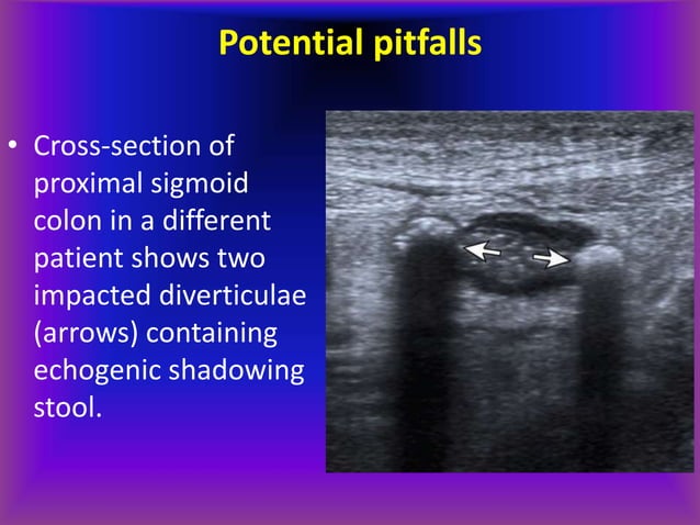 Ultrasound detection of colonic polyps Dr. Muhammad Bin Zulfiqar | PPTX ...