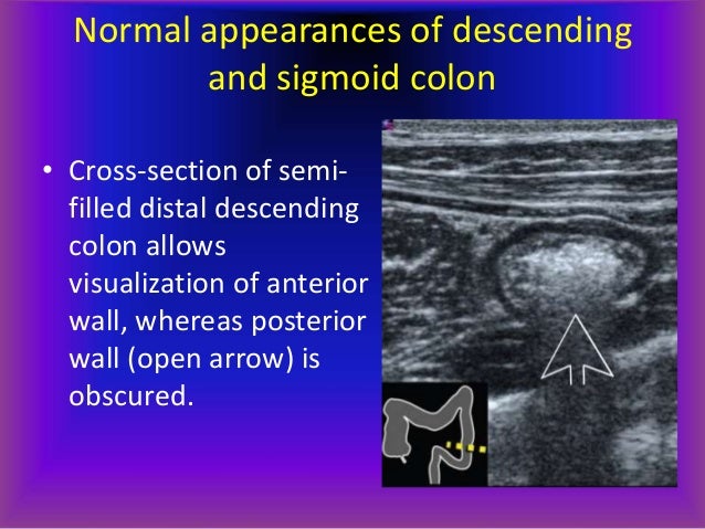 Ultrasound detection of colonic polyps Dr. Muhammad Bin Zulfiqar