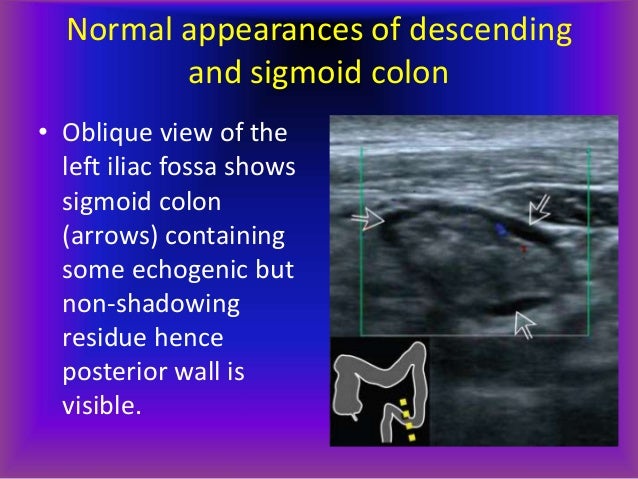 Ultrasound detection of colonic polyps Dr. Muhammad Bin Zulfiqar