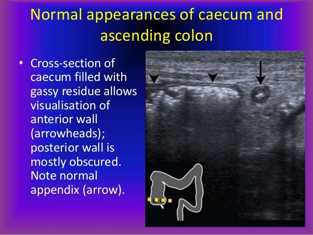Ultrasound detection of colonic polyps Dr. Muhammad Bin Zulfiqar