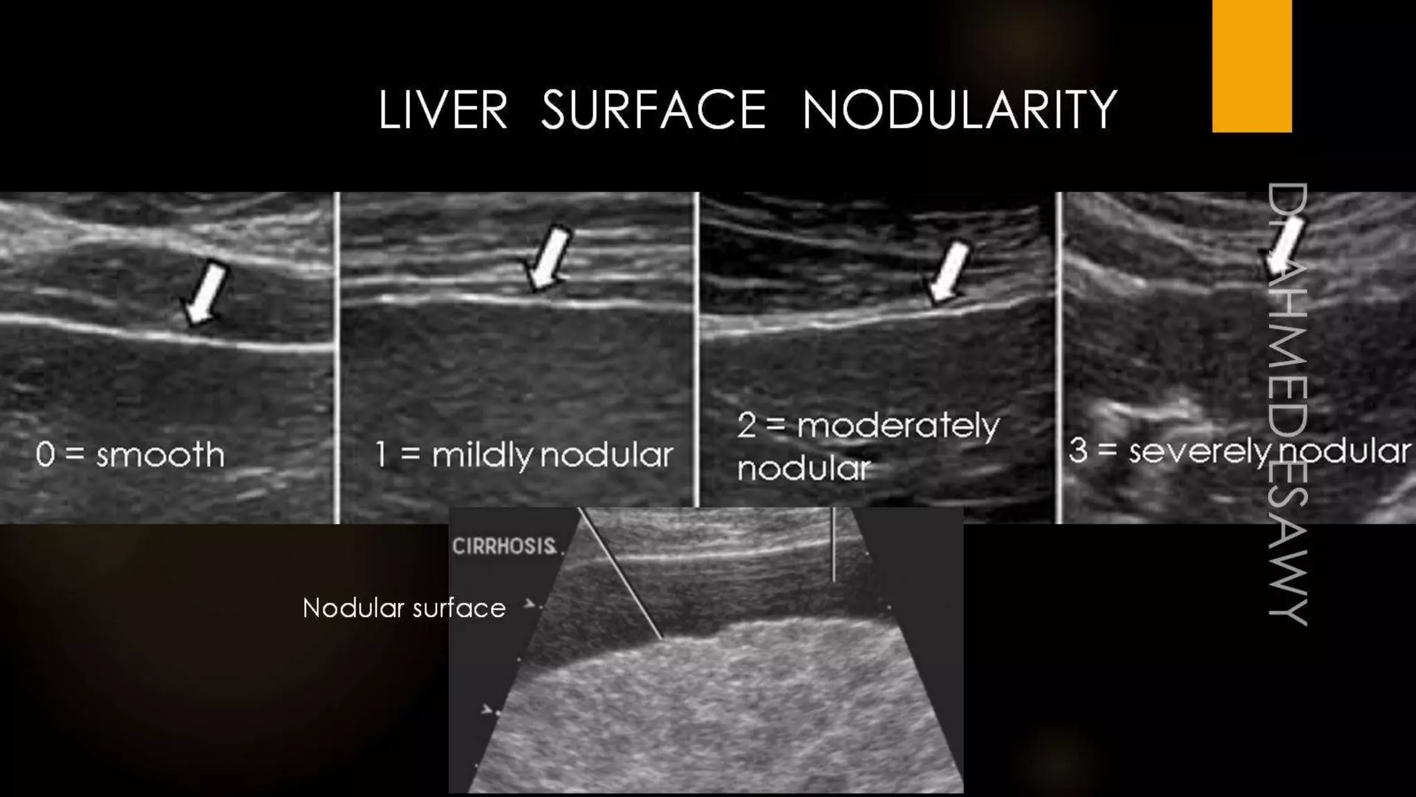 Ultrasound diffuse liver disease all things fibrosis,cirrhosis,us ...