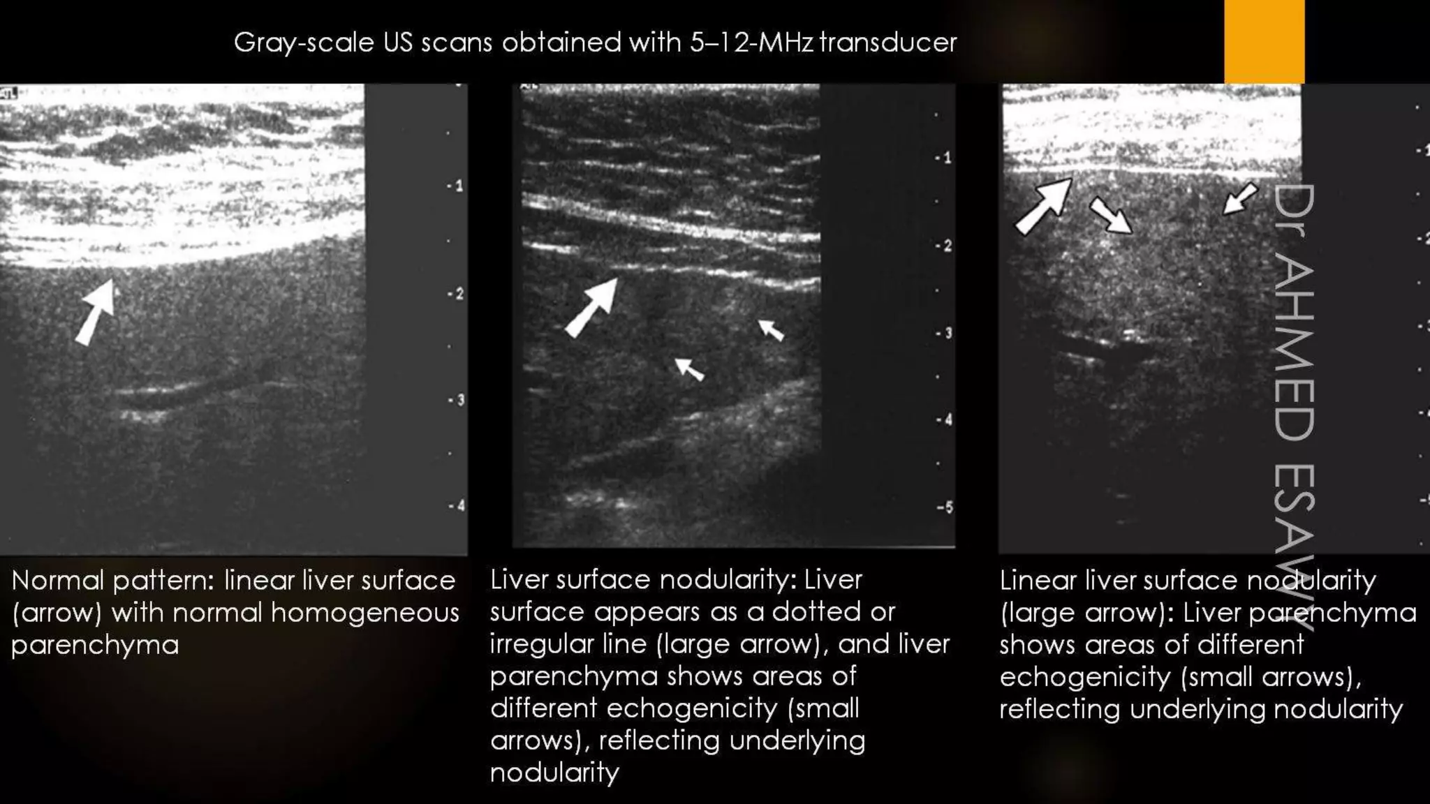 Ultrasound diffuse liver disease all things fibrosis,cirrhosis,us ...