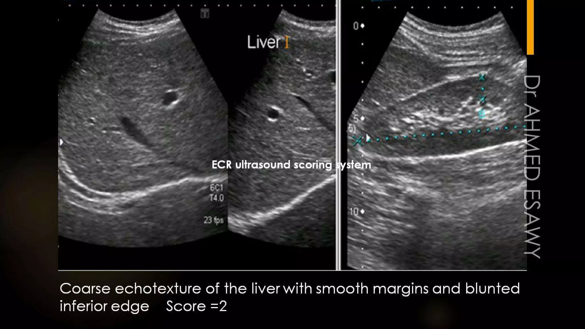Ultrasound diffuse liver disease all things fibrosis,cirrhosis,us scoring,ce lrad,fibroscan ...