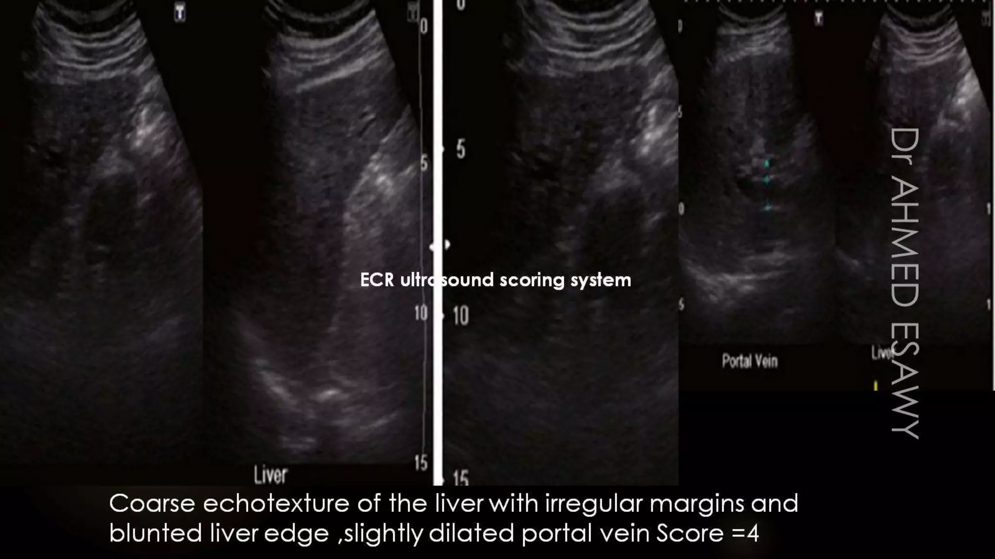 Ultrasound diffuse liver disease all things fibrosis,cirrhosis,us ...