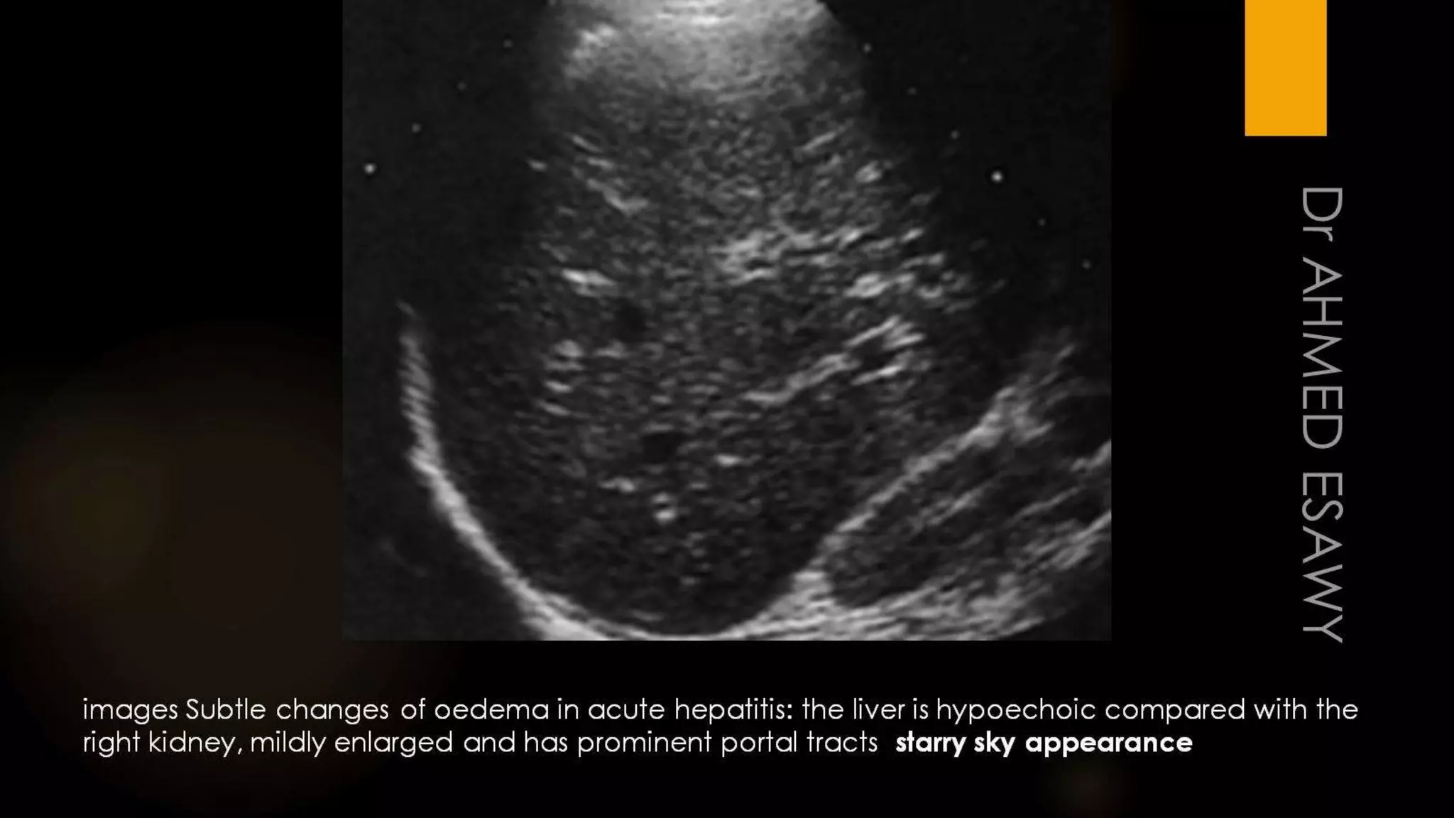 Ultrasound diffuse liver disease all things fibrosis,cirrhosis,us ...
