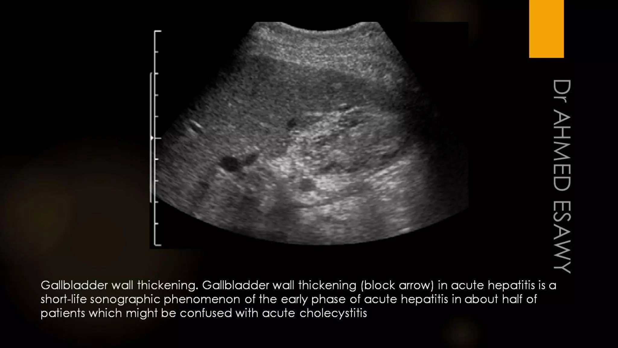 Ultrasound diffuse liver disease all things fibrosis,cirrhosis,us ...